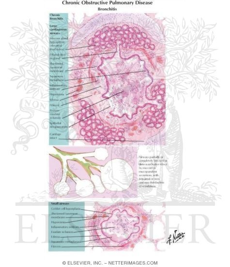 copd pathology outlines