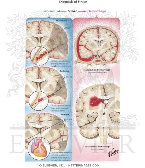 Diagnosis of Stroke
