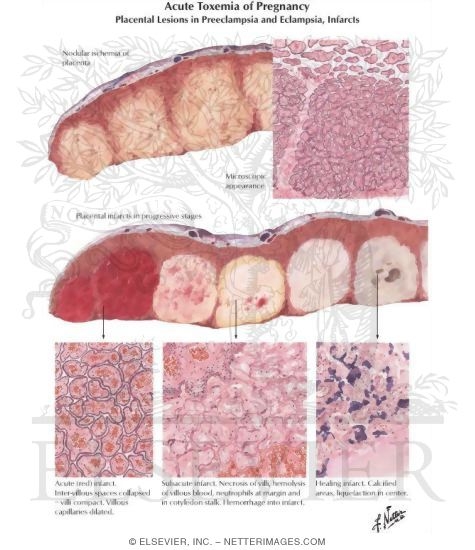 Acute Toxemia of Pregnancy IV - Placental Lesions in Preeclampsia and ...
