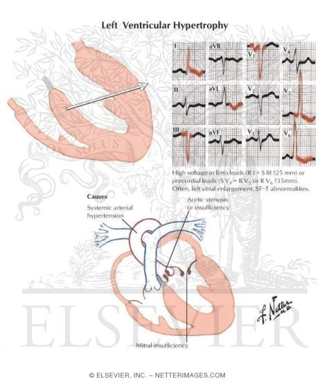 Ventricular Hypertrophy
