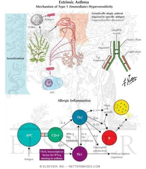 Extrinsic Asthma