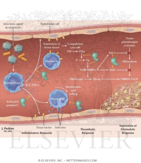 Septicemia