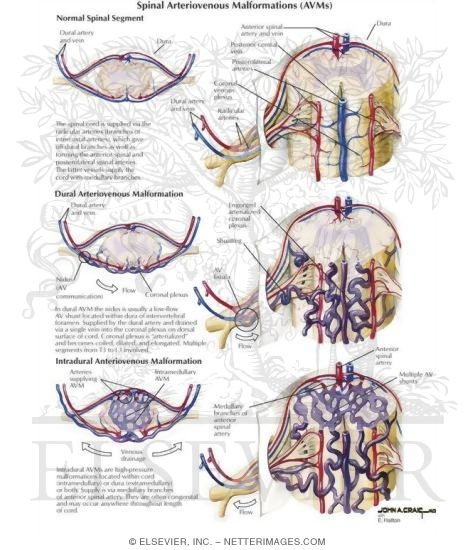 Spinal Arteriovenous Malformations (AVMs)