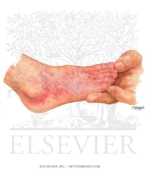 Excoriations of the Foot