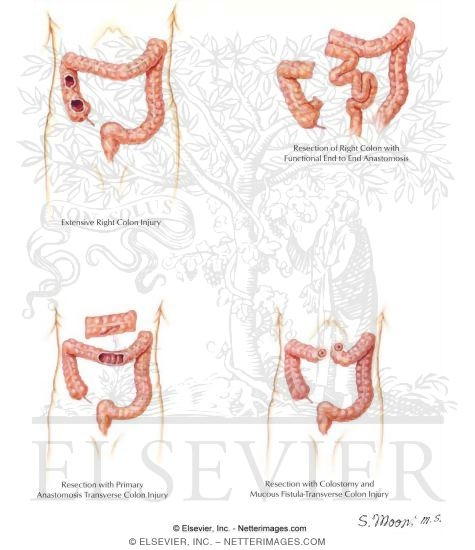 Abdominal Wounds of Colon