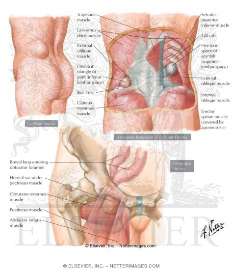 sciatic foramen hernia