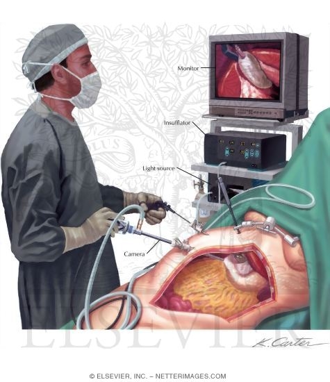 Laparoscopy (Peritoneoscopy)
