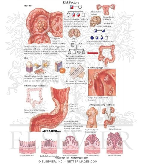 Neoplasms of the Large Bowel: Colon Polyps