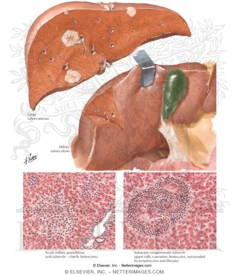 tubercle tuberculosis