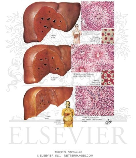 The Liver In Heart Failure: Cardiac Liver and Shock
