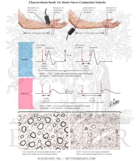 Hereditary Motor-Sensory Neuropathy Type I: Motor Nerve Conduction Velocity