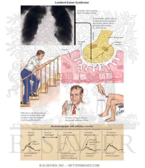Lambert-Eaton Syndrome