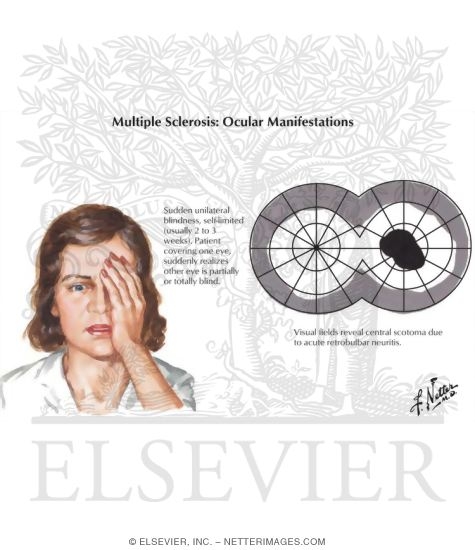 Multiple Sclerosis: Ocular Manifestations Giant Cell Arteritis: Ocular ...