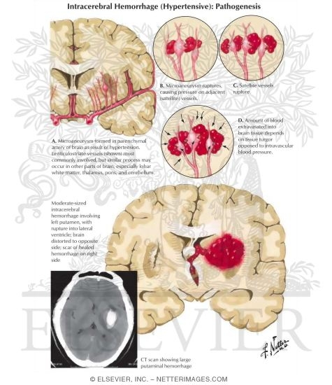 Intracerebral Hemorrhage Pathophysiology