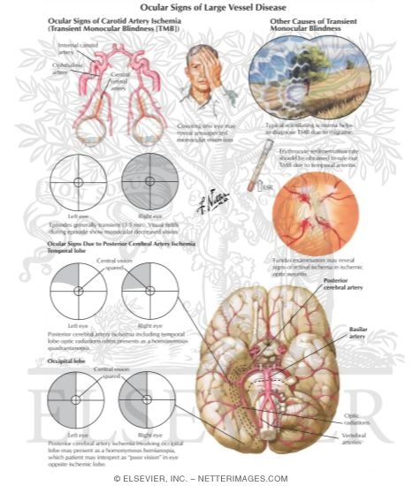 Ocular Signs of Large Vessel Disease