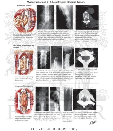 Myelographic and CT Characteristics of Spinal Tumors