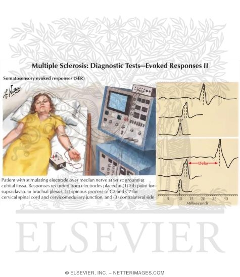 Multiple Sclerosis: Diagnostic Tests - Evoked Responses II