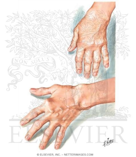 Early and Moderate Hand Involvement In Rheumatoid Arthritis