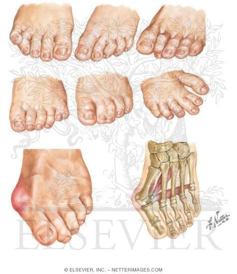 Toe Deformities