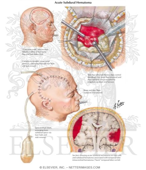 subdural hematoma