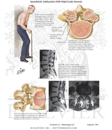 Spondylotic Subluxation With High-Grade Stenosis