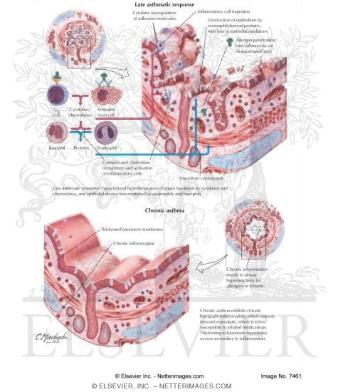 wheeze pathophysiology
