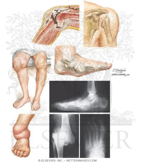 charcot joint knee