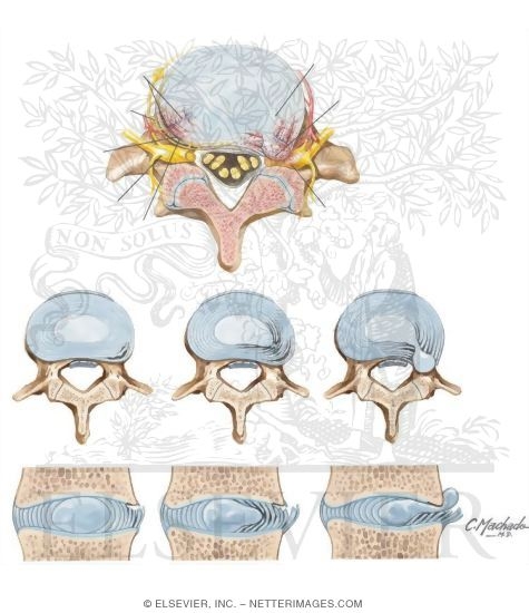 Lumbar Disk Herniation