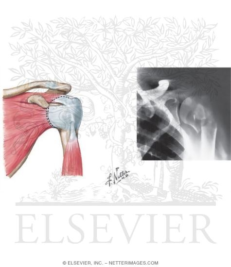 Fracture of Proximal Humerus