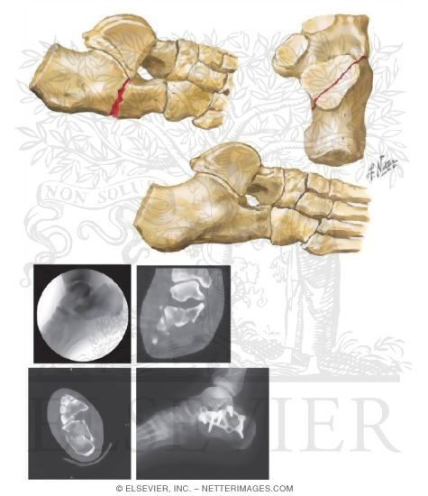Intraarticular Fracture of the Calcaneus