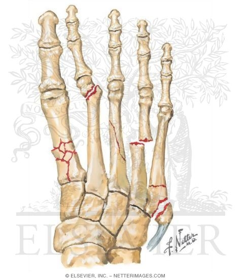 Injury to Metatarsals