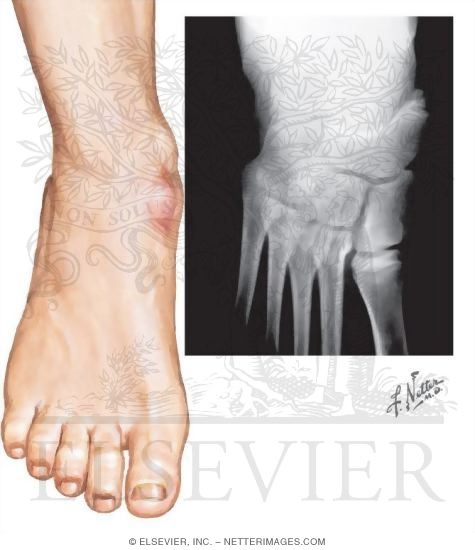 Accessory Navicular