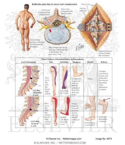 lumbar triangle herniation
