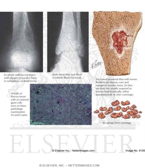 Nonossifying Fibroma