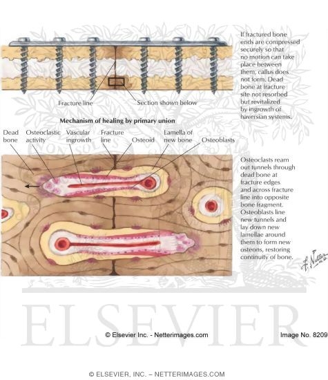 Primary Union In Fractures