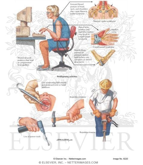 Compression Neuropathy in Workplace