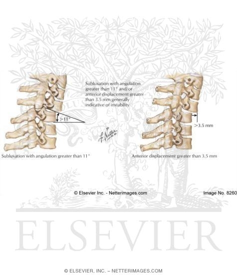 Radiographic Signs of Cervical Spine Instability