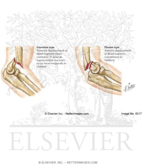 Supracondylar Fracture of the Humerus