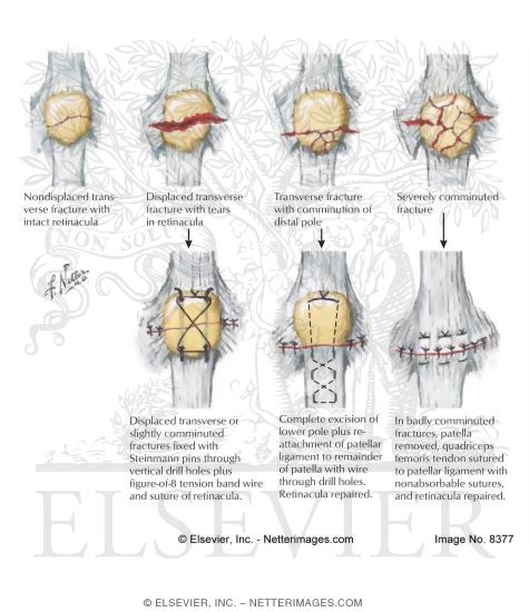 Knee Injuries: Knee Injuries From Falling On Knee Cap