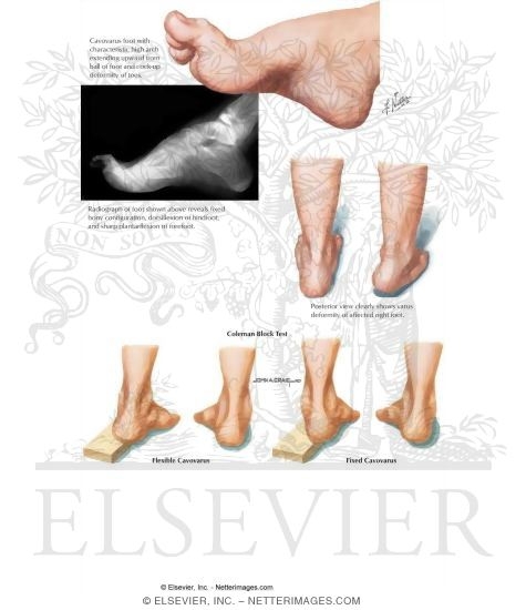 Cavovarus Foot