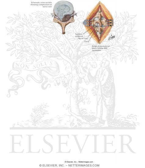 Lumbar Disc Herniation: Clinical Manifestations