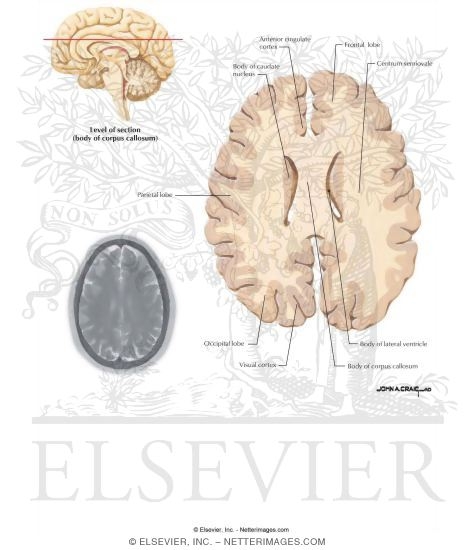 Body of Corpus Callosum