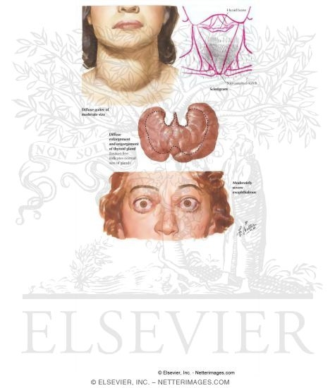 Graves Disease: Thyroid and Ocular Pathology