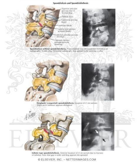 Spondylolysis and Spondylolisthesis