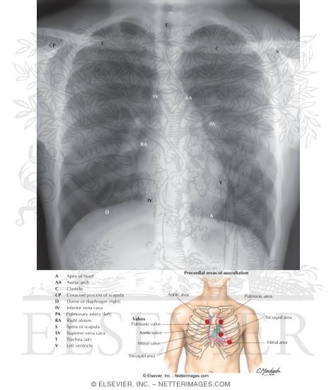 Radiograph of Chest