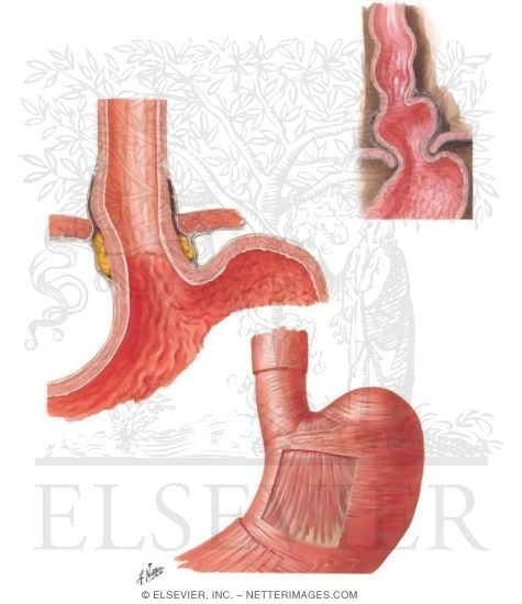Esophagogastric Junction