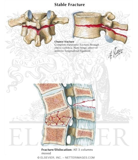 Stable Fracture Vertebral Dislocation and Fractures