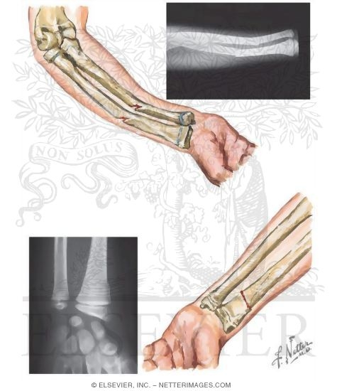Fracture of the Forearm