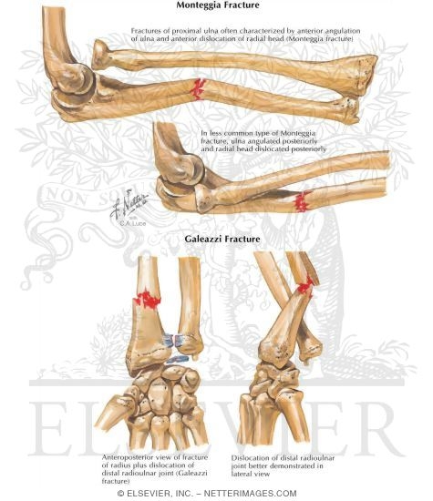 Monteggia Fracture Galeazzi Fracture Monteggia Fracture Galeazzi Fracture