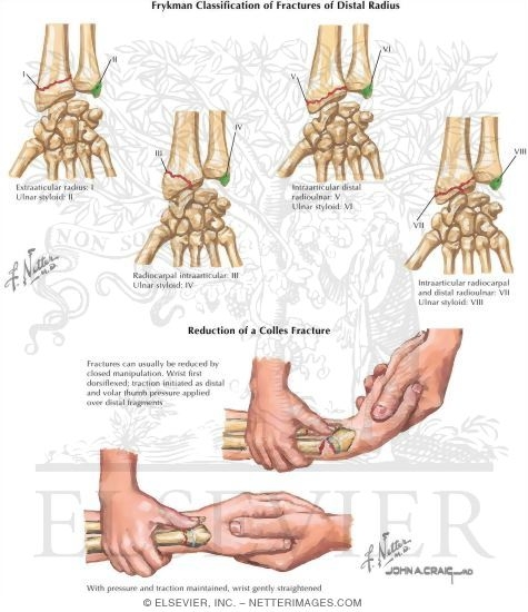Frykman Classification Of Fractures Of Distal Radius Reduction Of A